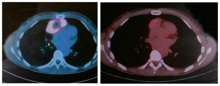 For Haddon Twp. Cancer Survivor, Beating Disease Only the First Step ...